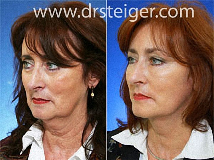 facelift-before-and-after1 | Steiger Facial Plastic Surgery | Boca ...