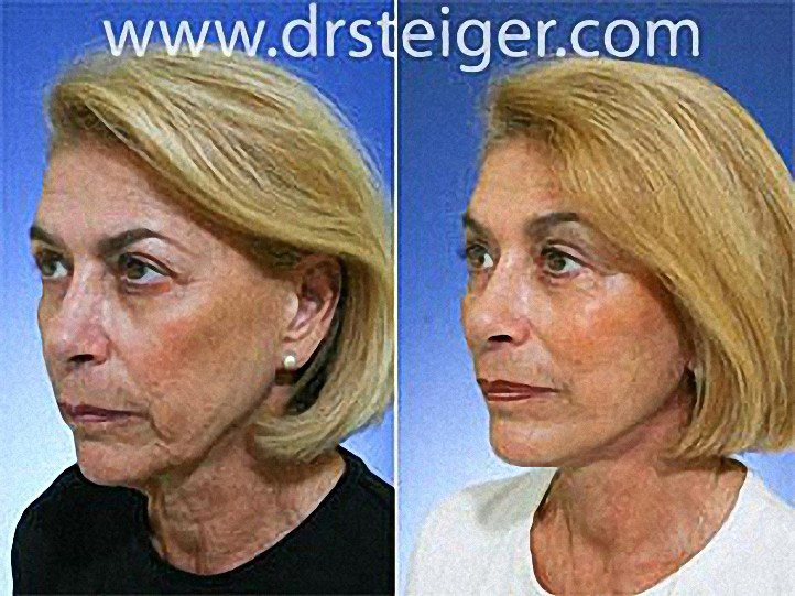 Facelift Before and After Photos | Deep Plane Facelift