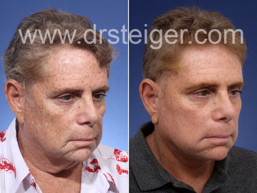 Facelift Before and After Photos | Deep Plane Facelift
