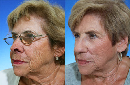 MOHS Surgery Reconstruction Before and After Photos
