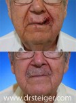 MOHS Surgery Reconstruction Before and After Photos