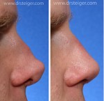 Revision Rhinoplasty Before and After Photos