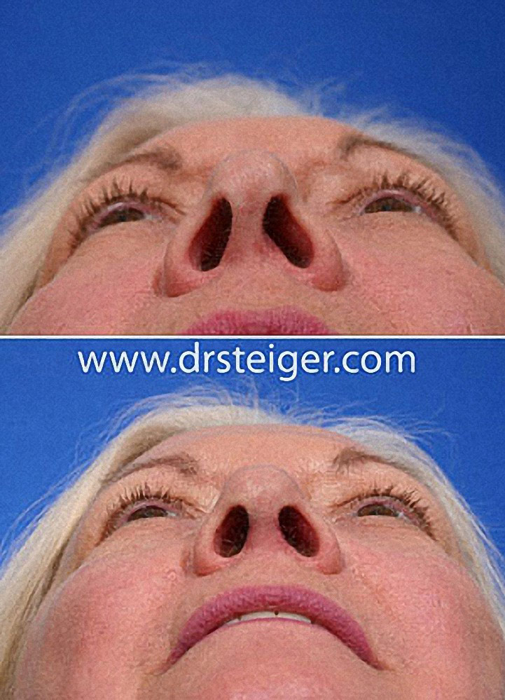 revision-rhinoplasty-base-nose1 | Steiger Facial Plastic Surgery | Boca ...