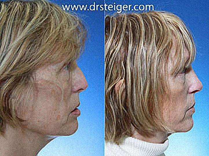 revision-rhinoplasty-nostril1 | Steiger Facial Plastic Surgery | Boca ...