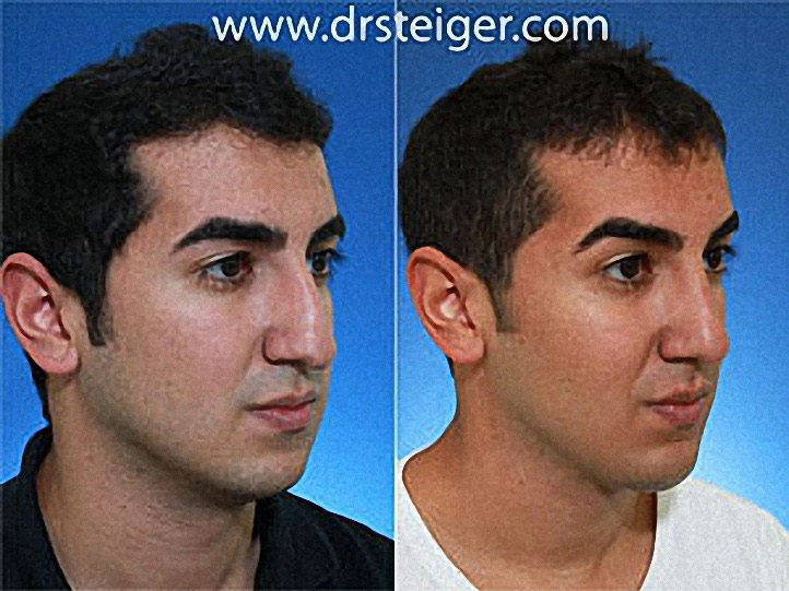 rhinoplasty-chin-before-after1 | Steiger Facial Plastic Surgery | Boca ...