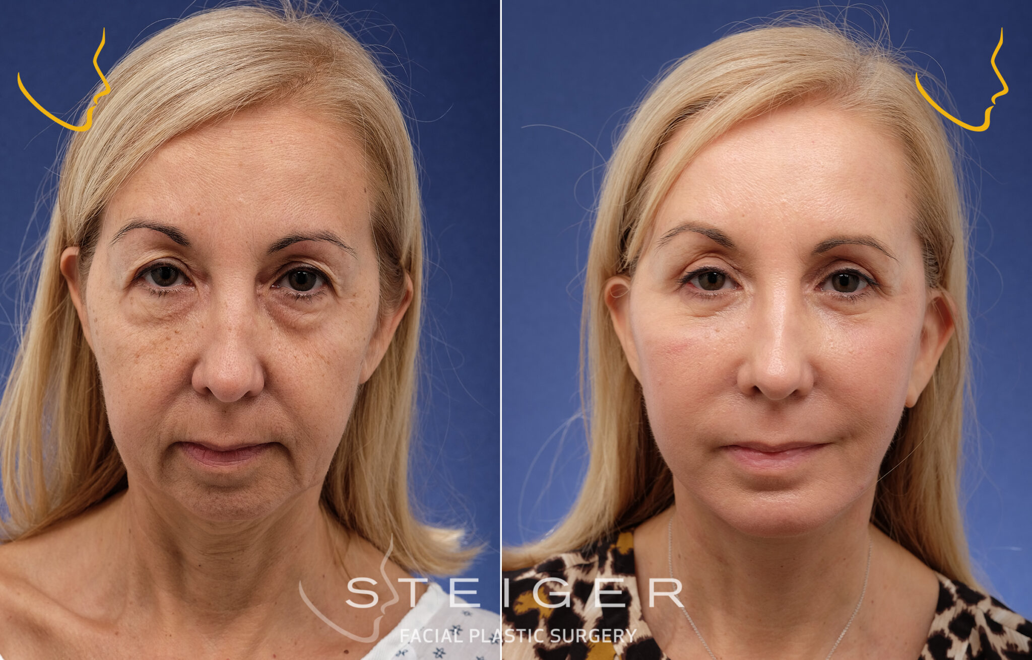 Facelift Before and After Photos | Deep Plane Facelift