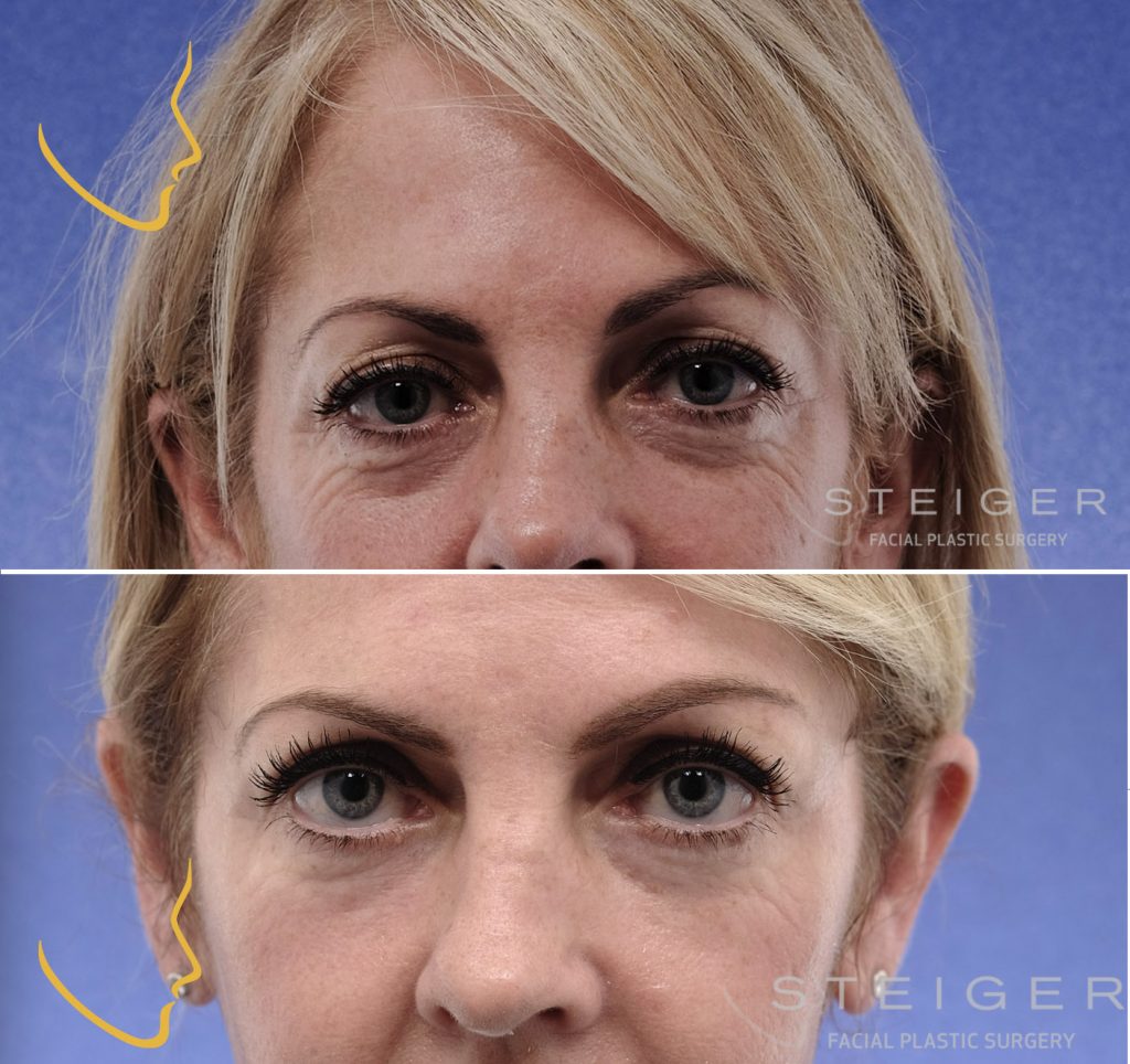 Sofwave South Florida | Non-Surgical Face, Neck, Chest Tightening