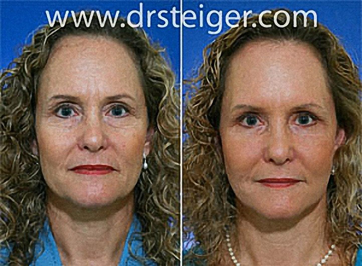 vertical-lift-plastic-surgery1 | Steiger Facial Plastic Surgery | Boca ...
