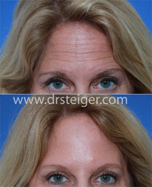 Xeomin Before and After Photos Boca Raton